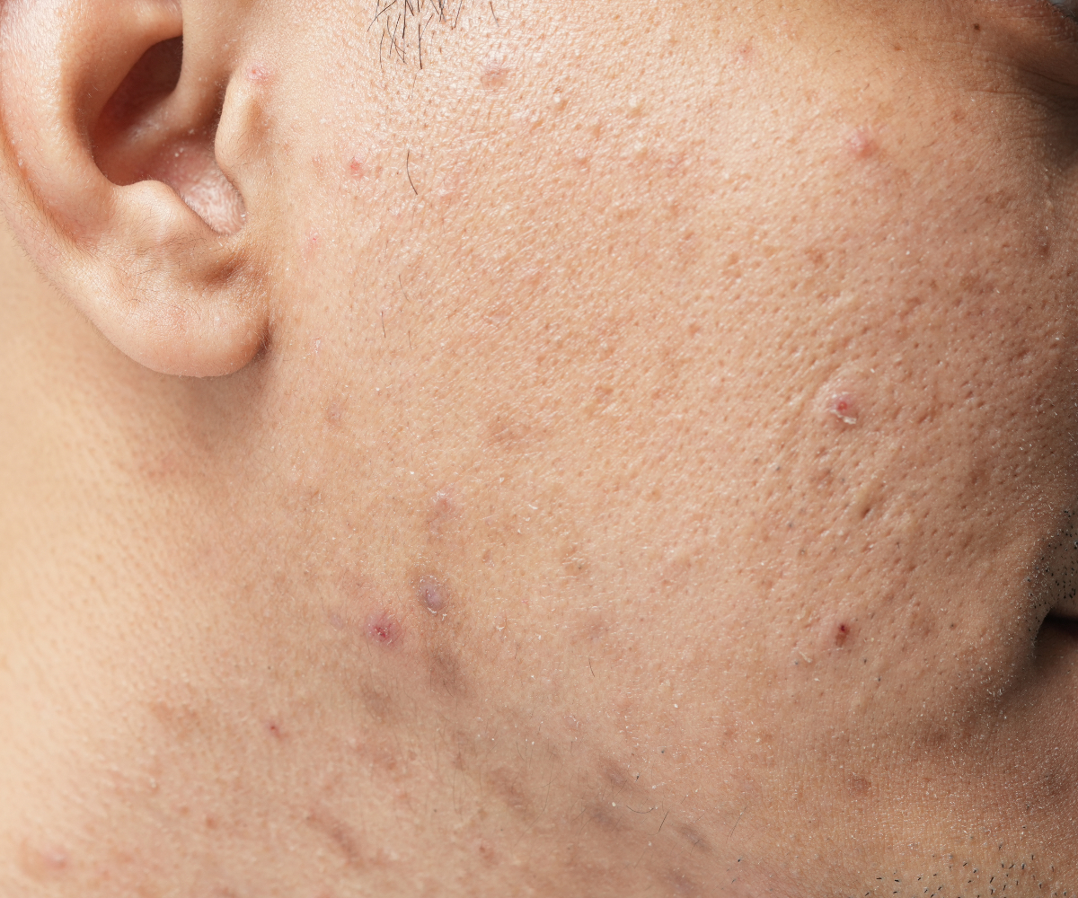 How can you tell if your acne prone skin is too sensitive for acids ...